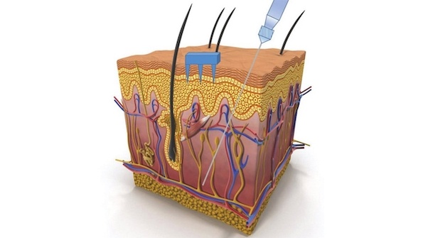 Microneedles Extract Fluid for Wearable Sensors - Tech Briefs