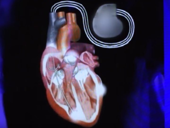 Pacemaker-Like Device Restores Heart Function in Cancer Survivors ...