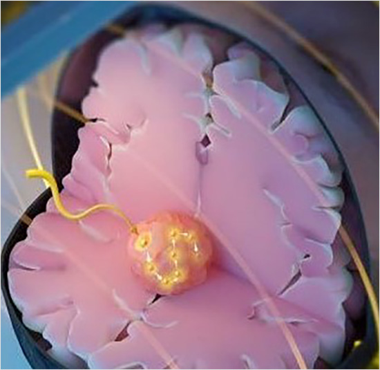 Magnetic Seeds Used to Heat and Kill Cancer - Tech Briefs